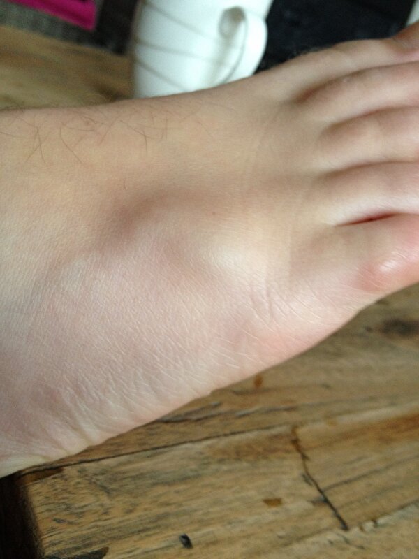 Bult op voet • Bokt.nl